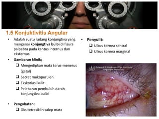 Matamerah konjuktivitis | PPT