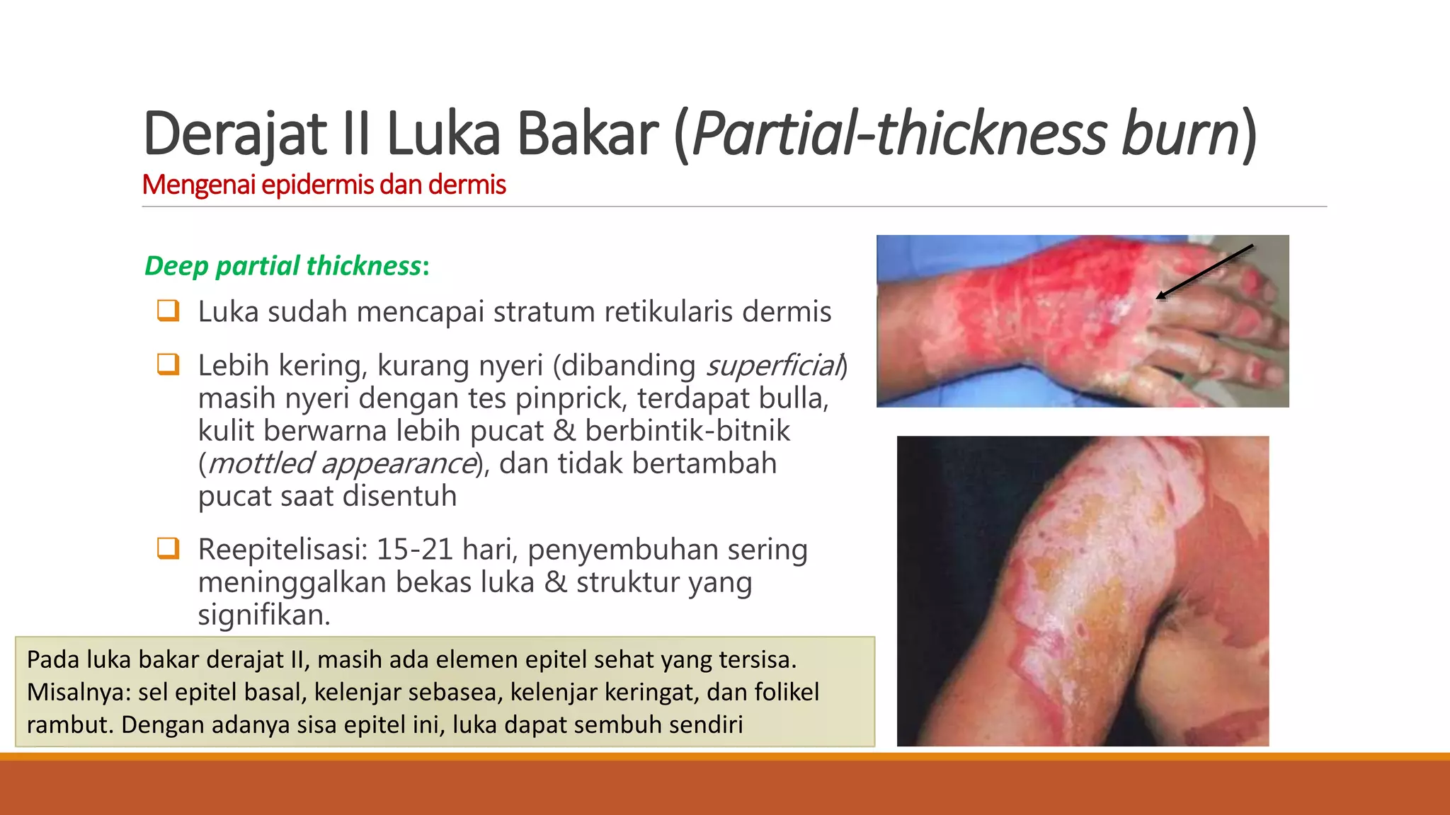 Materi 1_Konsep luka bakar.pptx