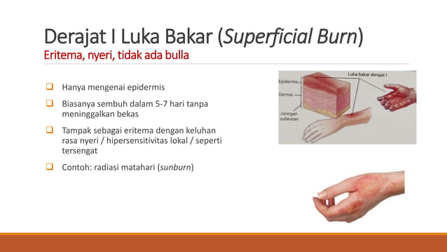Materi 1_Konsep luka bakar.pptx