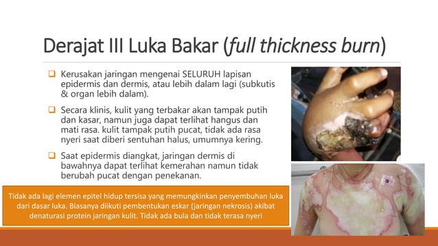 Materi 1_Konsep luka bakar.pptx