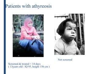 Skrining Hipotiroid Kongenital pada bayi | PPT