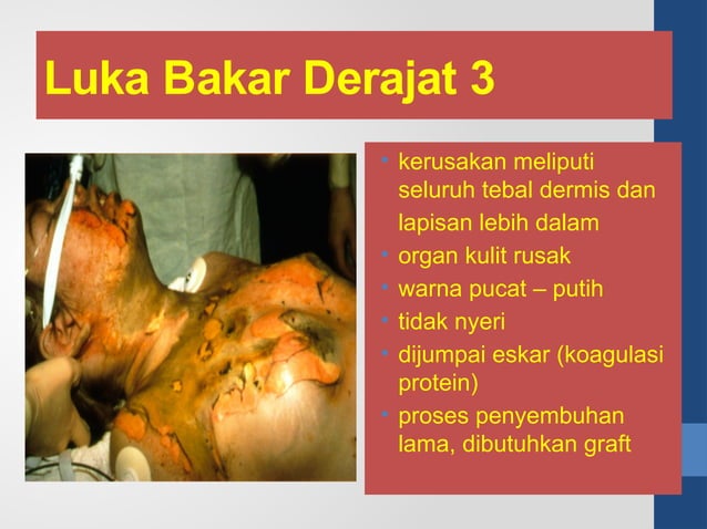 Materi 9 KGD LUKA BAKAR.pptx