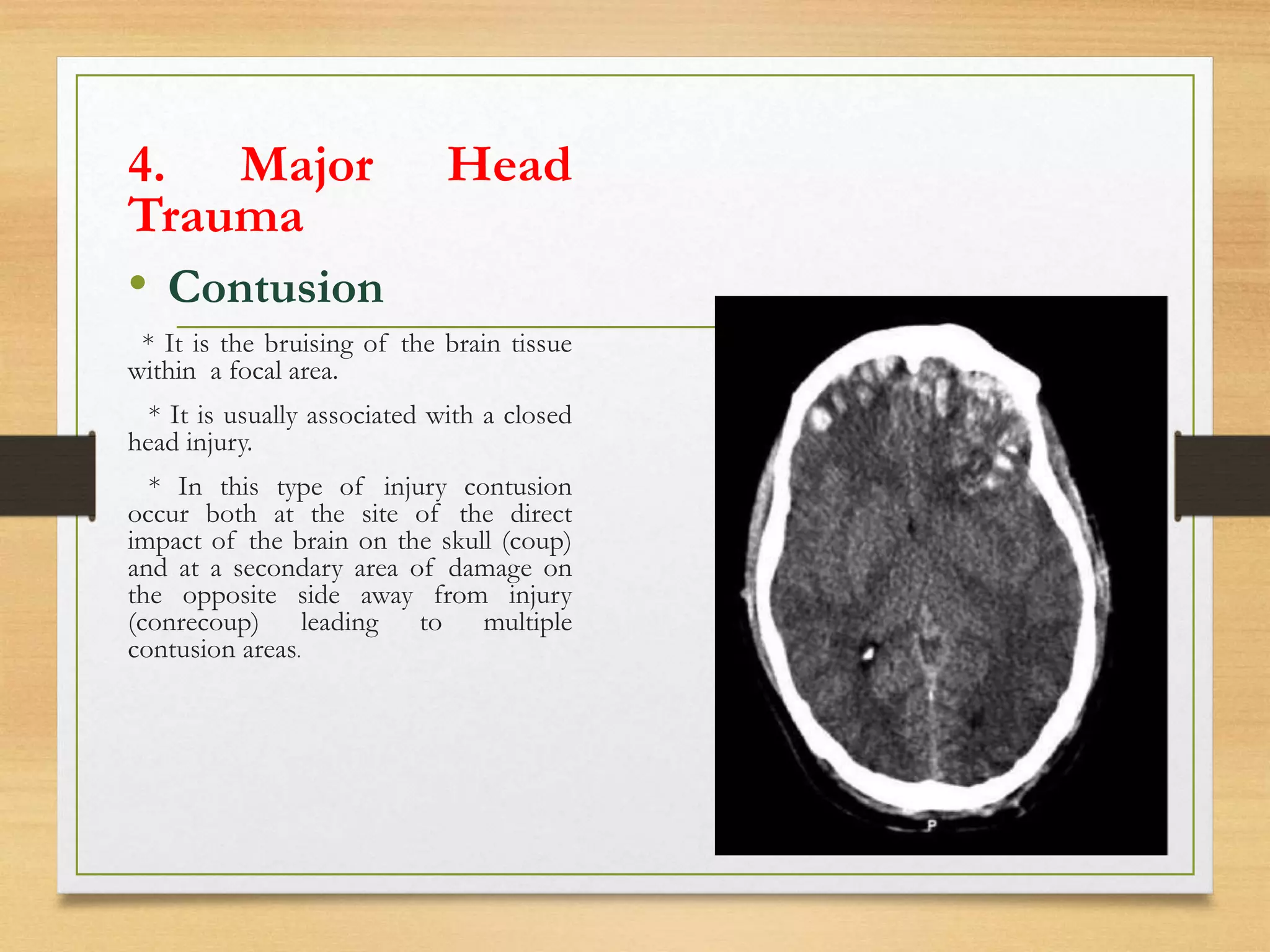 Head injury and nursing management | PPTX