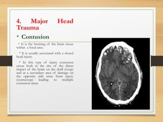 Head injury and nursing management | PPTX