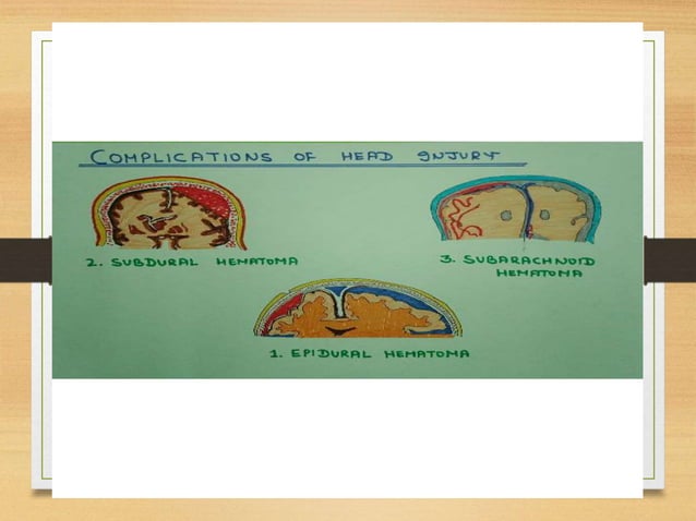 Head injury and nursing management | PPTX