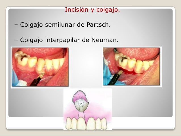 Material en odontologia y cirugia endodontica