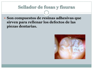 selladores de fosetas y fisuras en odontología | PPTX