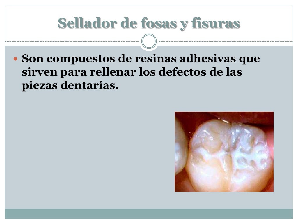 selladores de fosetas y fisuras en odontología