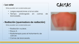 MATERIAL S09 MANEJO DE QUEMADURAS , todo sobre quemaduras | PPTX