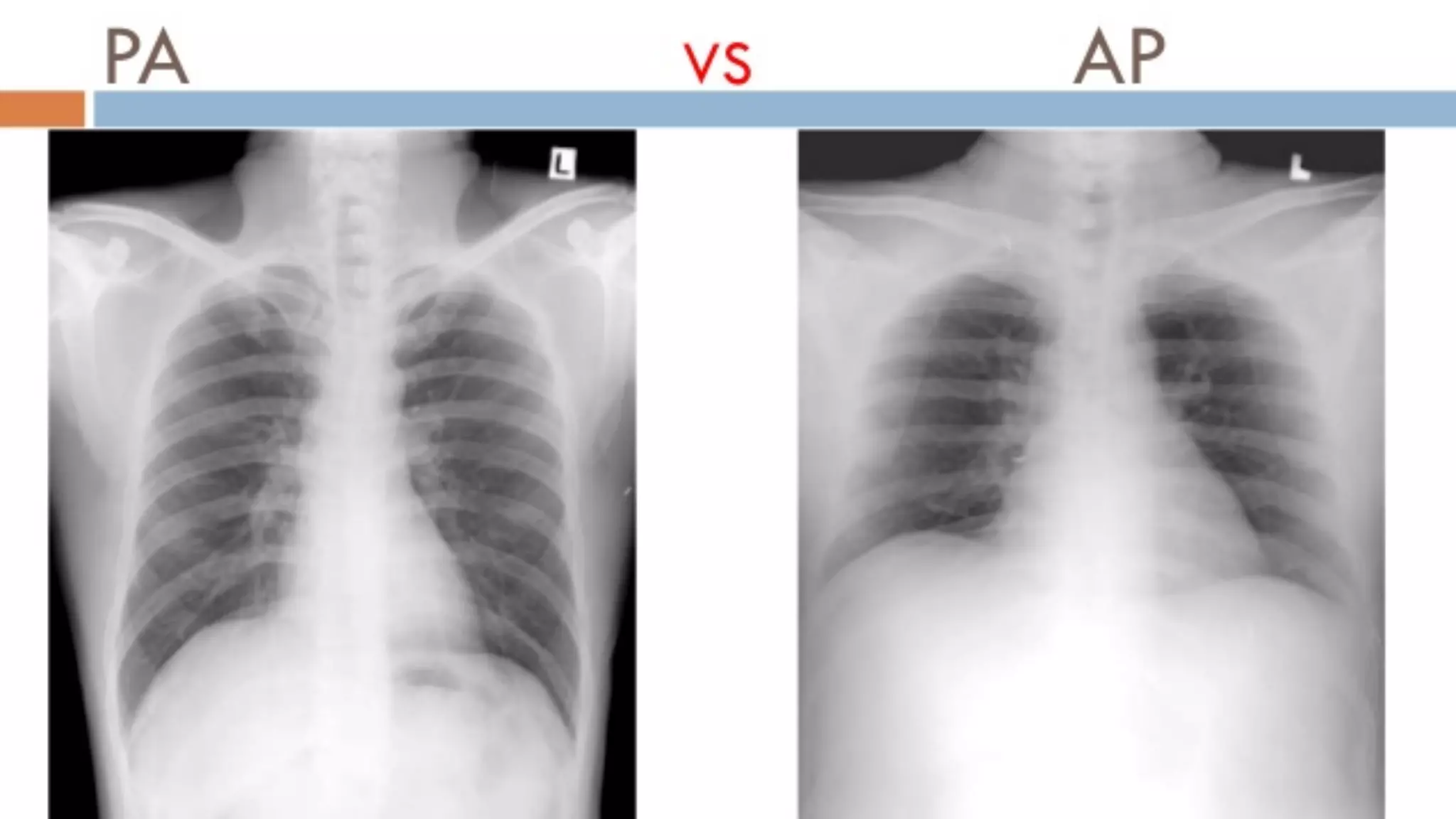 Interpretasi Rontgen Dada atau Foto Thoraks | PDF