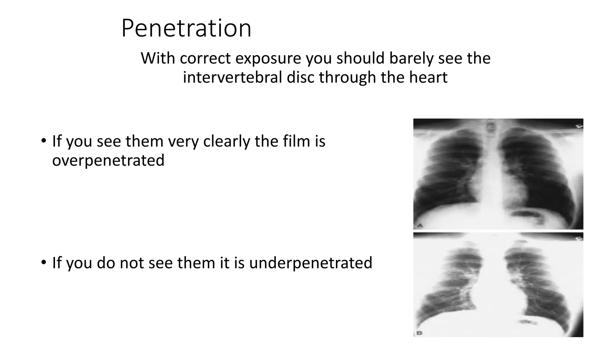 Interpretasi Rontgen Dada atau Foto Thoraks | PDF