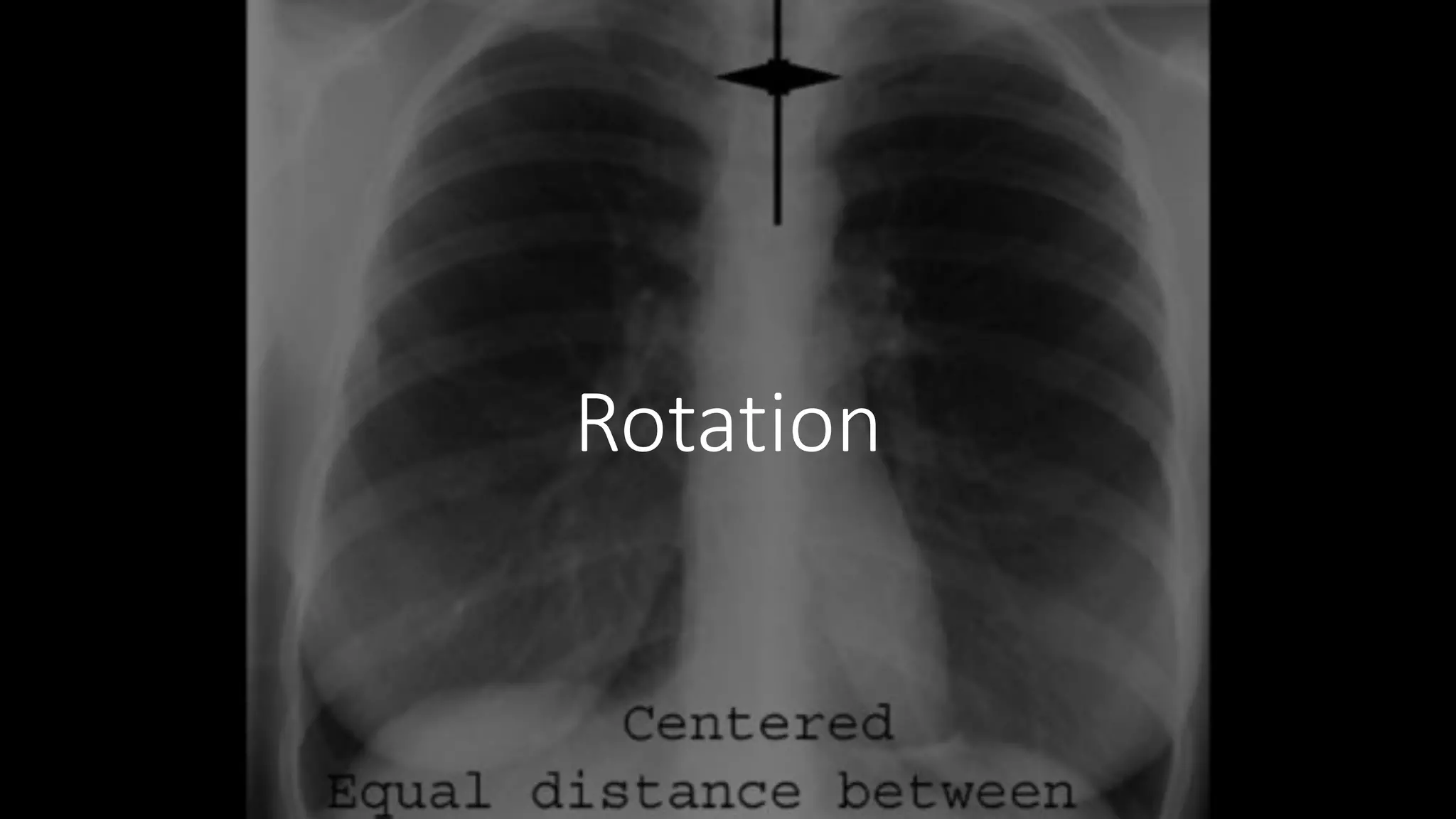 Interpretasi Rontgen Dada atau Foto Thoraks | PDF