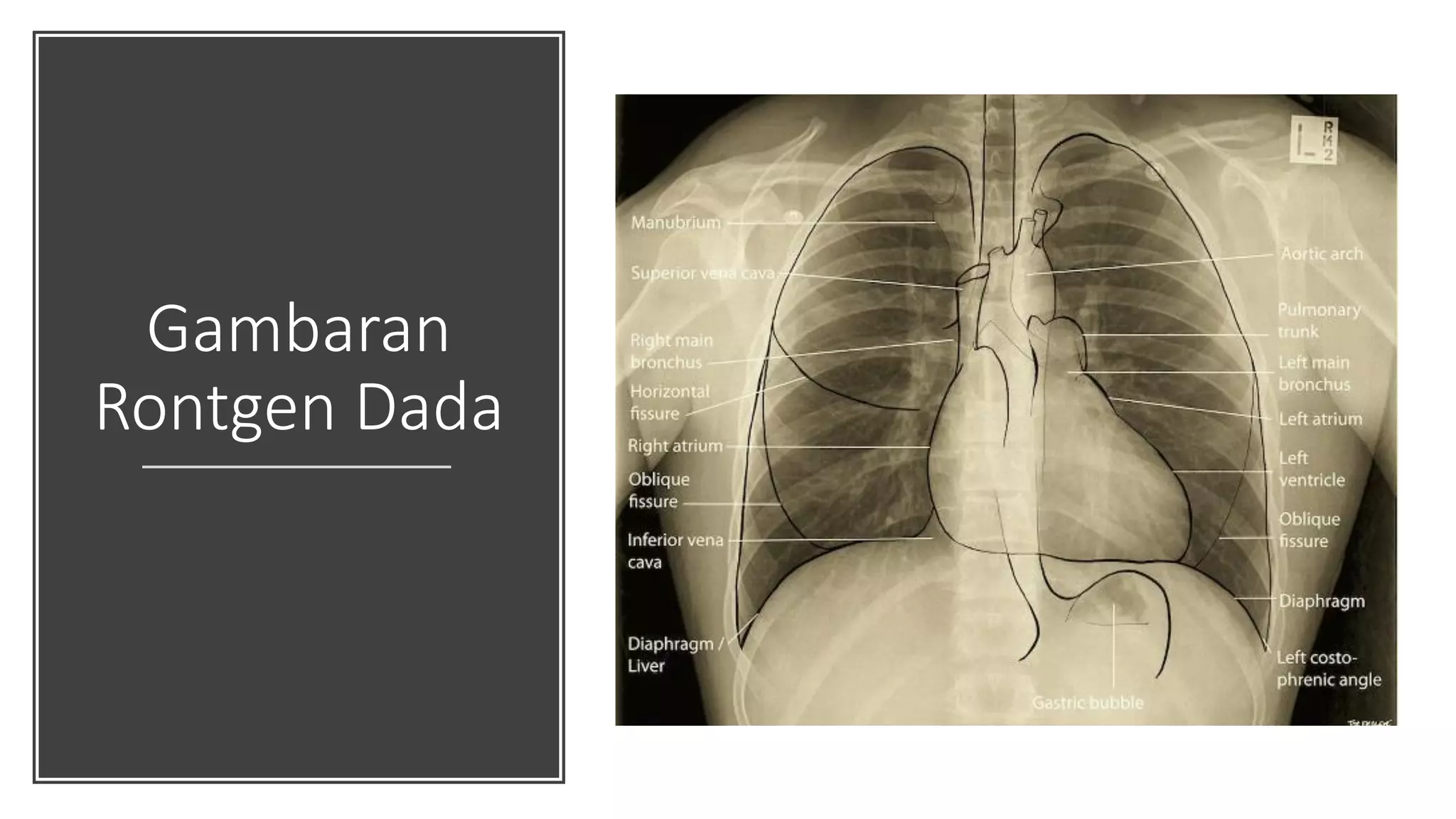 Interpretasi Rontgen Dada atau Foto Thoraks | PDF