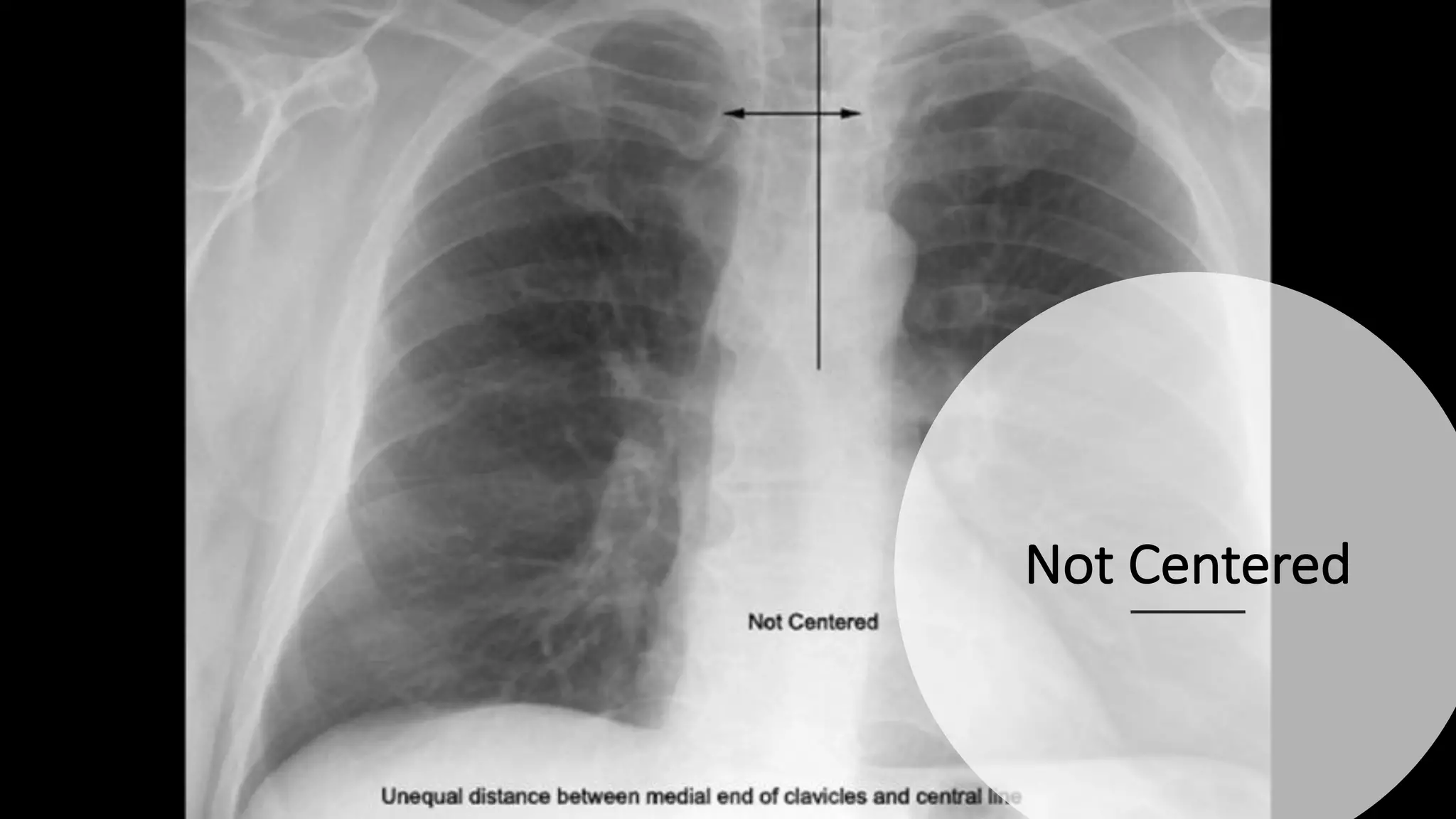 Interpretasi Rontgen Dada atau Foto Thoraks | PDF
