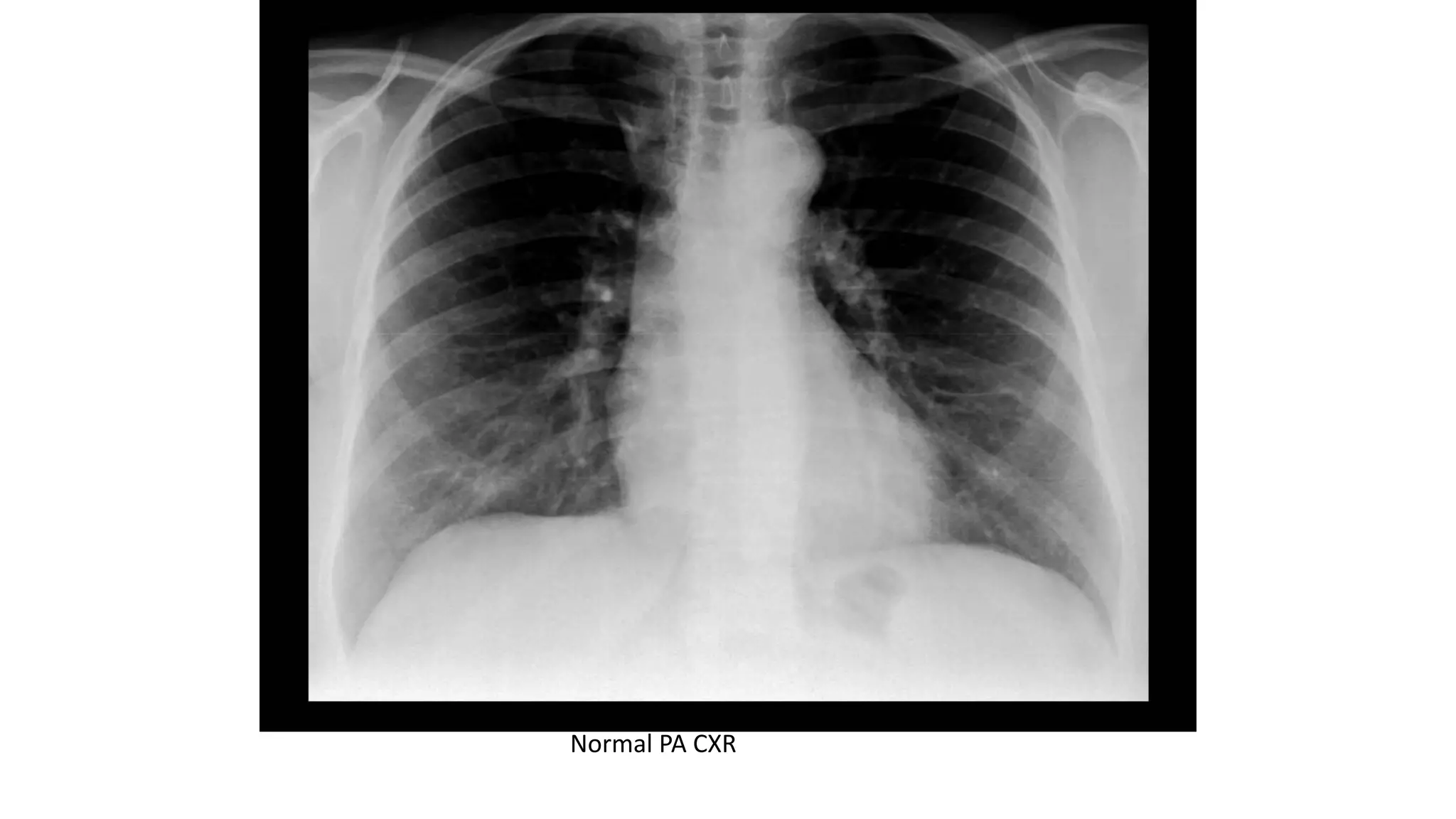 Interpretasi Rontgen Dada atau Foto Thoraks | PDF