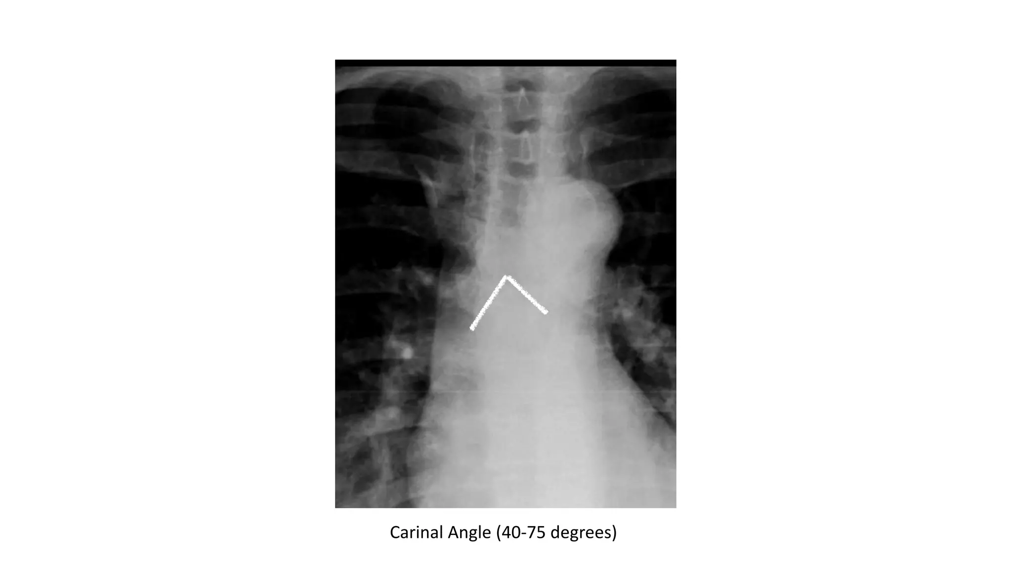 Interpretasi Rontgen Dada atau Foto Thoraks | PDF