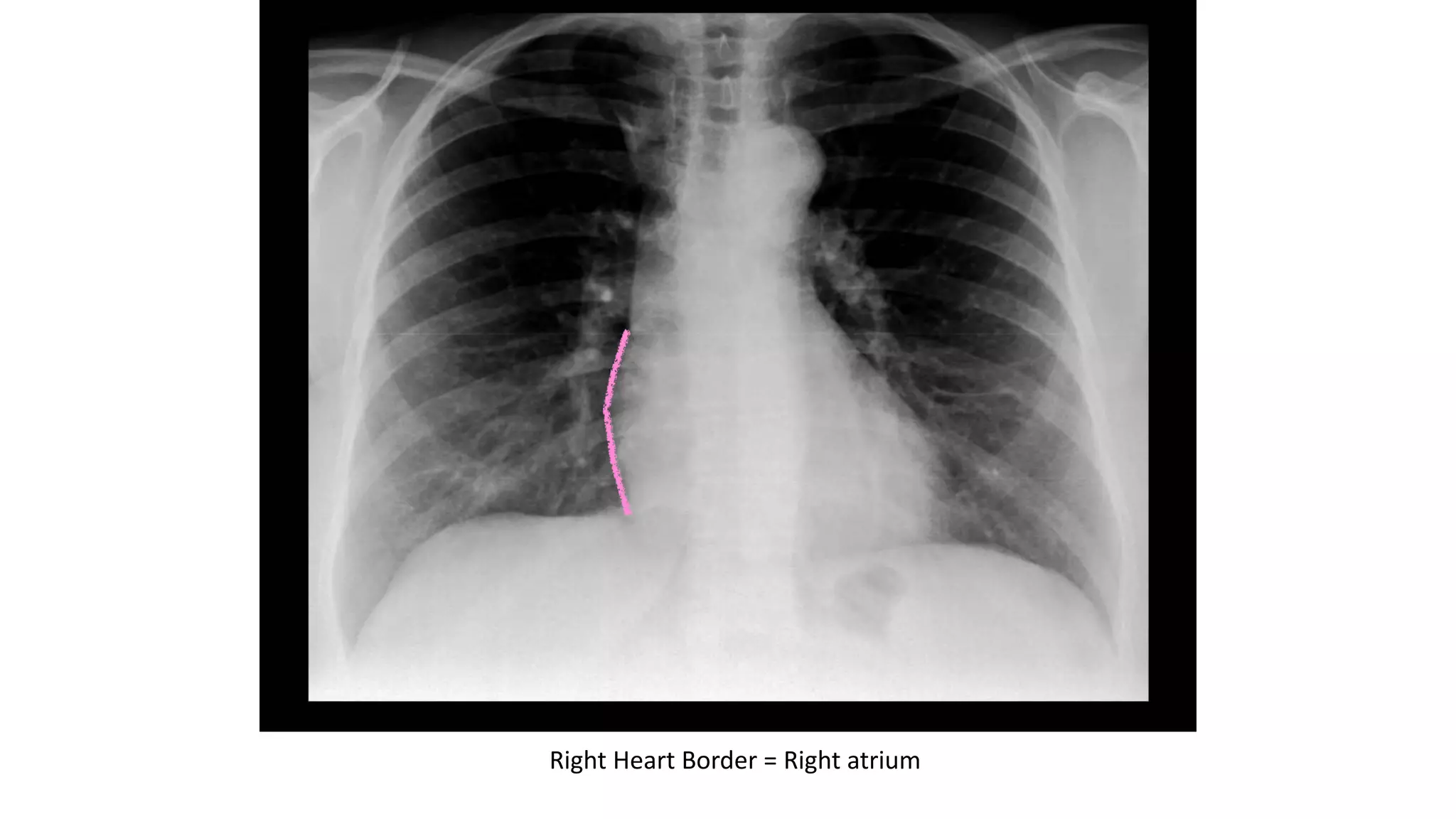 Interpretasi Rontgen Dada atau Foto Thoraks | PDF