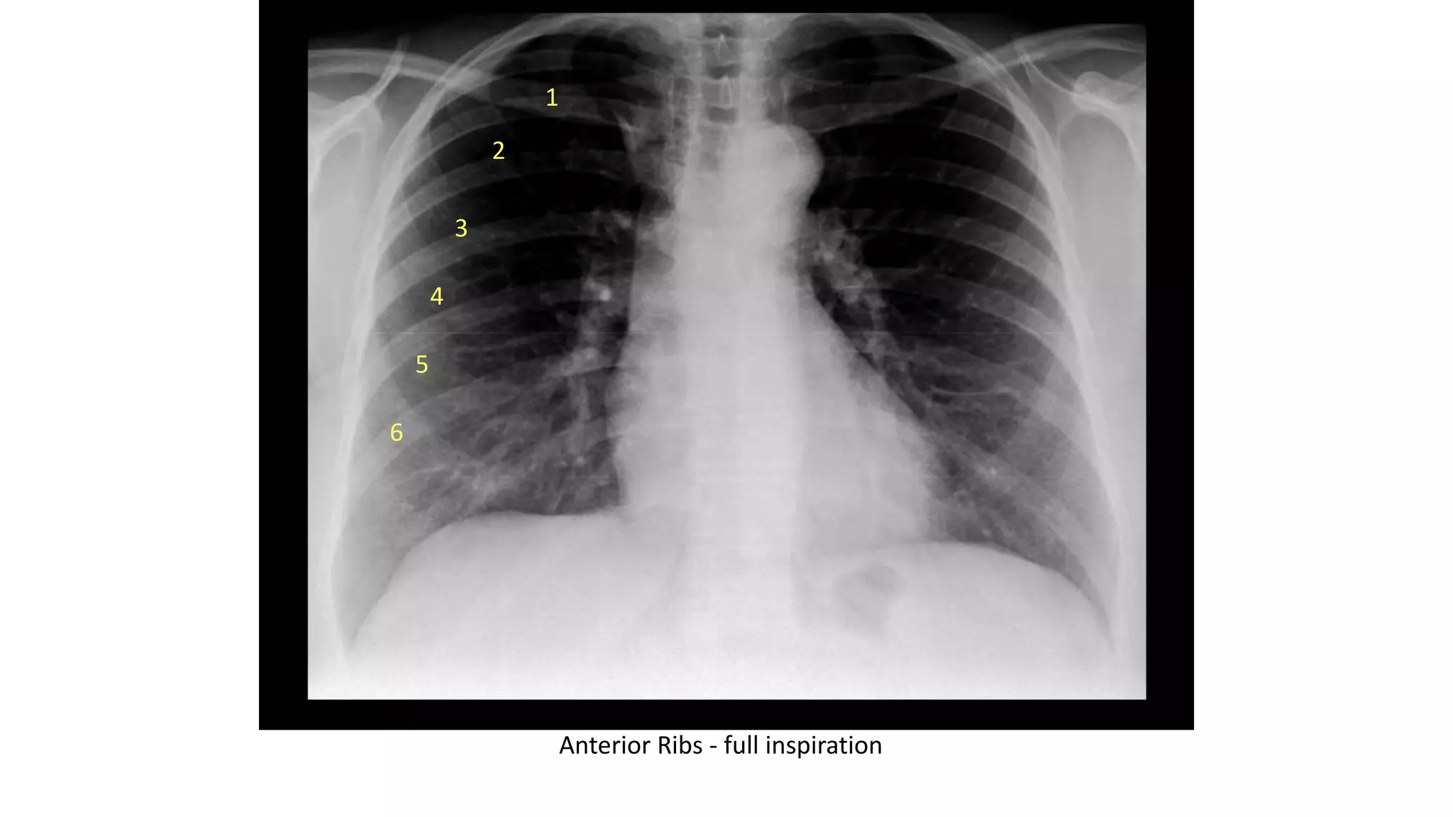 Interpretasi Rontgen Dada atau Foto Thoraks | PDF