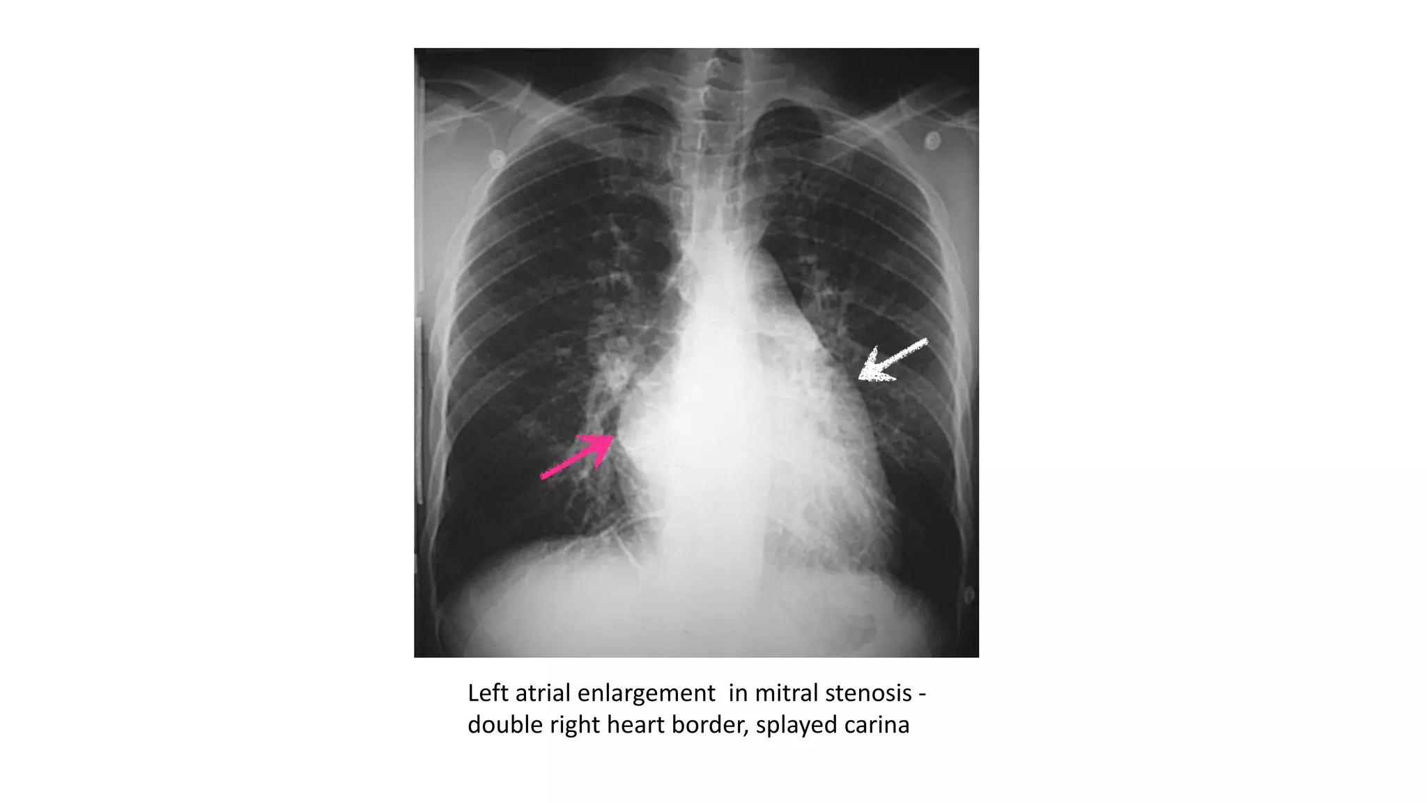 Interpretasi Rontgen Dada atau Foto Thoraks | PDF