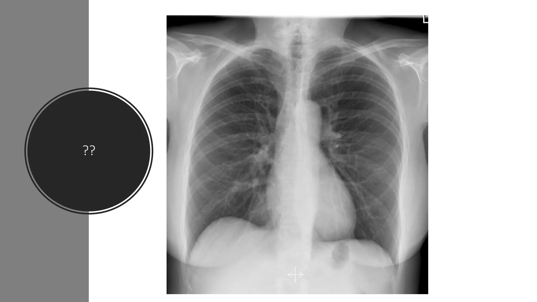 Interpretasi Rontgen Dada atau Foto Thoraks | PDF