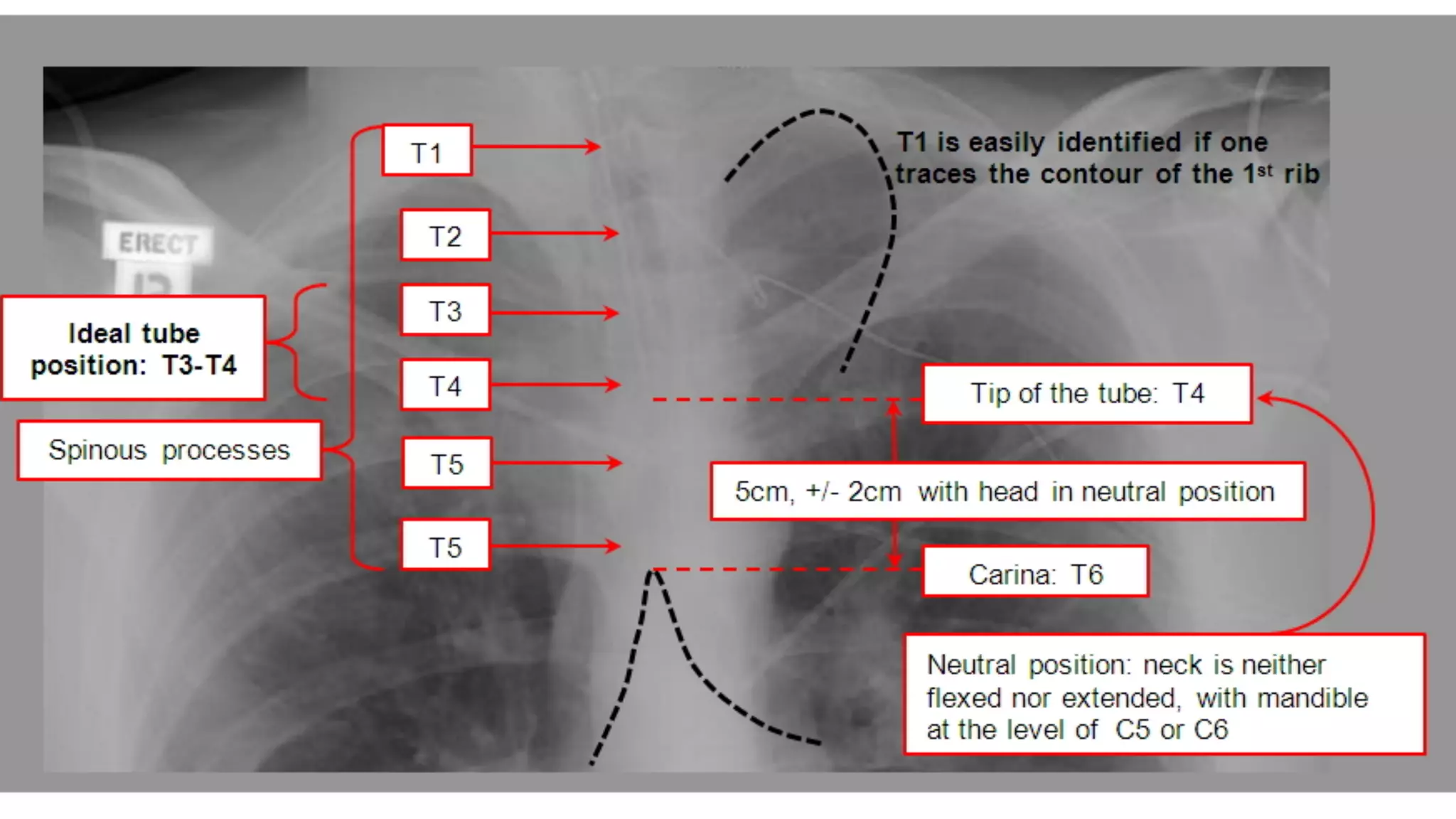Interpretasi Rontgen Dada atau Foto Thoraks | PDF