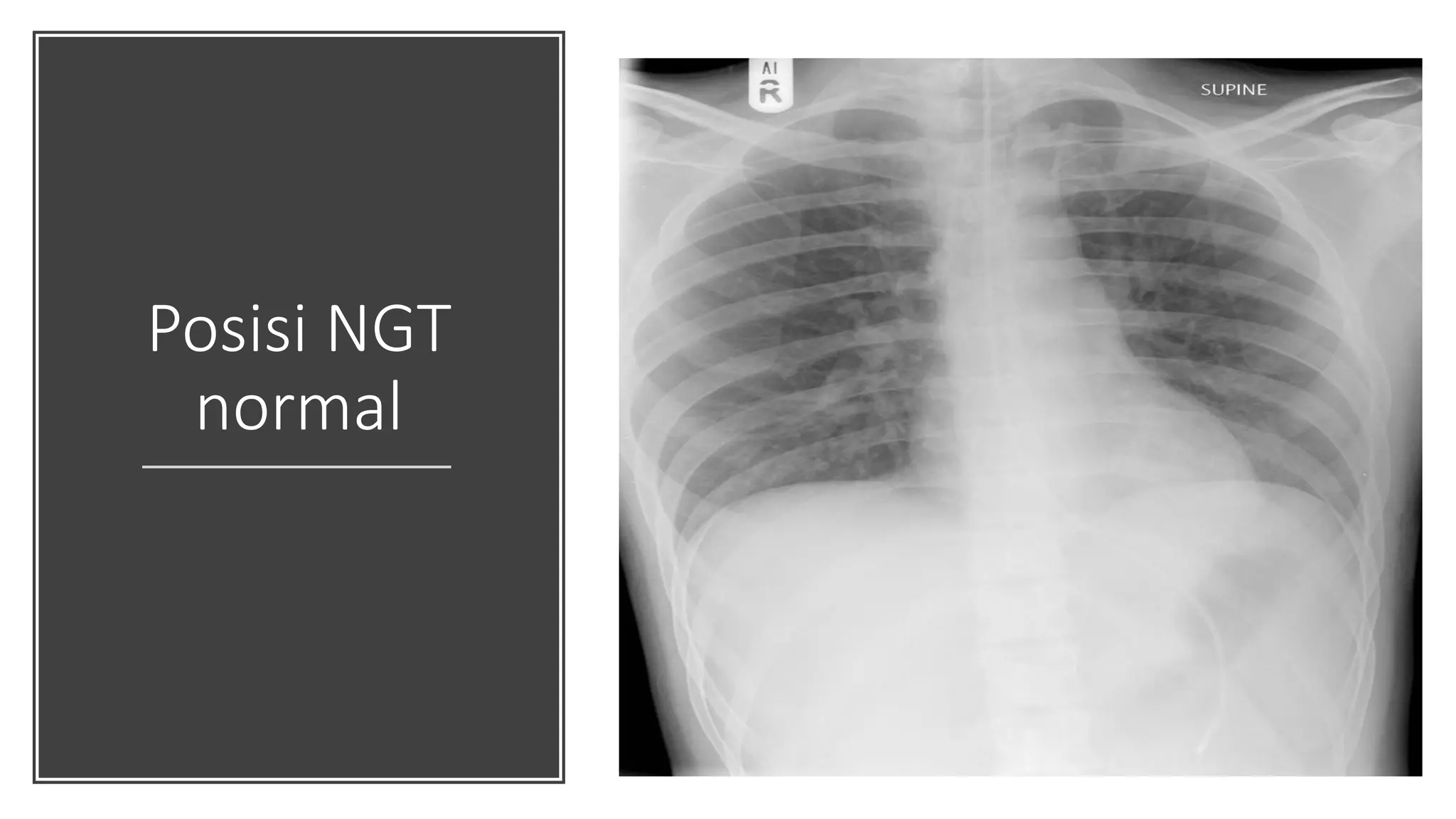 Interpretasi Rontgen Dada atau Foto Thoraks | PDF