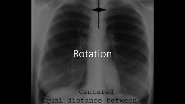 Interpretasi Rontgen Dada atau Foto Thoraks | PDF