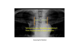 Interpretasi Rontgen Dada atau Foto Thoraks | PDF