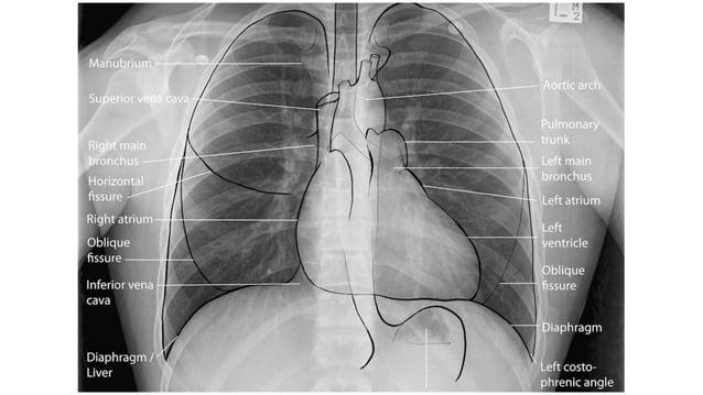Interpretasi Rontgen Dada atau Foto Thoraks | PDF