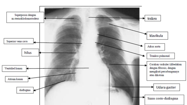 Interpretasi Rontgen Dada atau Foto Thoraks | PDF