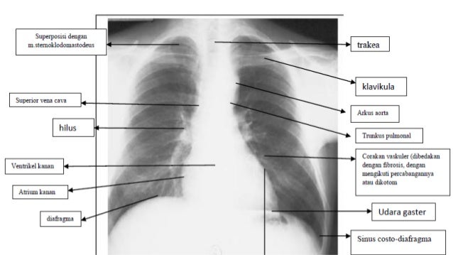 Interpretasi Rontgen Dada atau Foto Thoraks