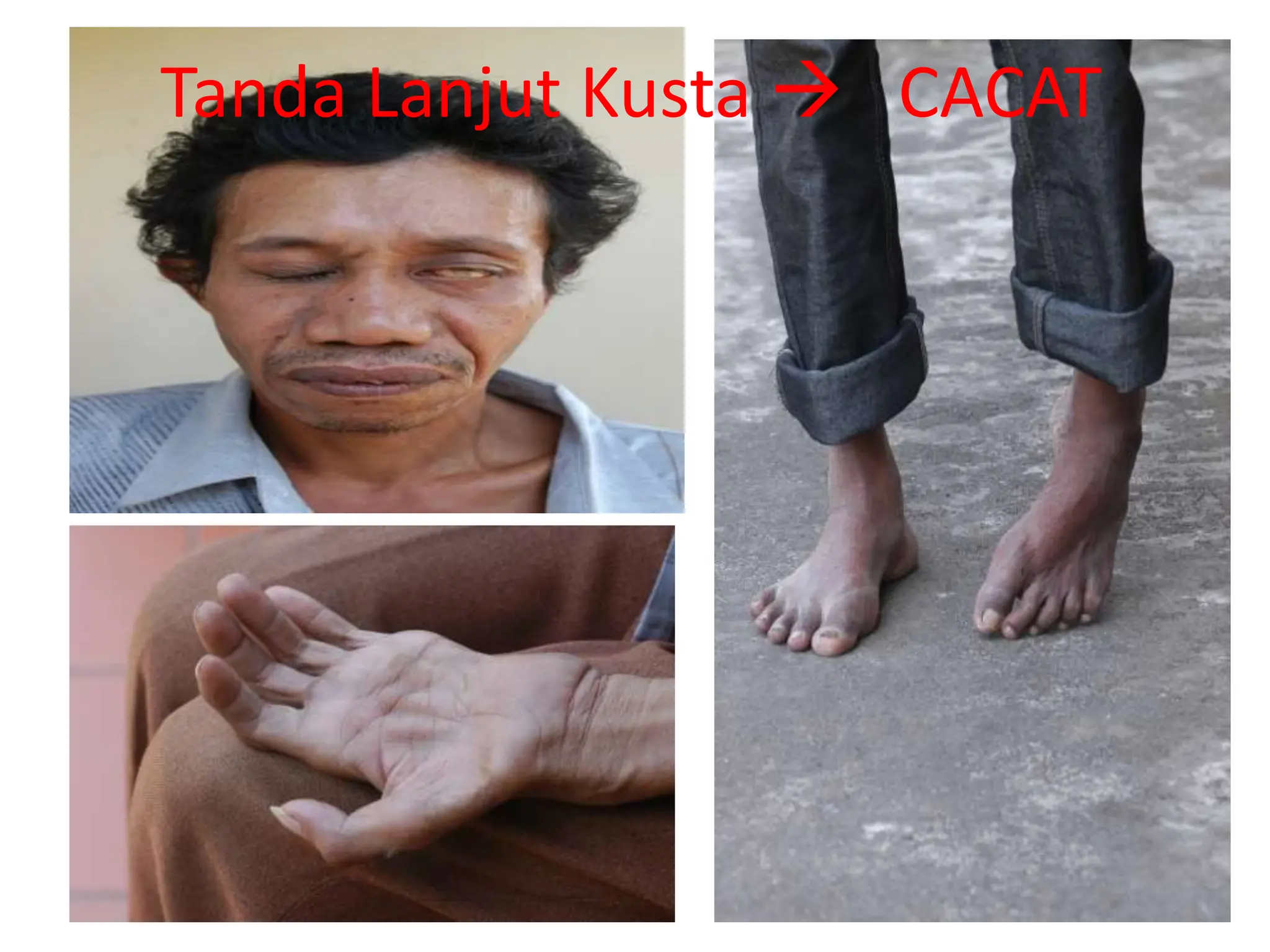 materi penyakit kusta untuk orang awam indonesia | PPTX