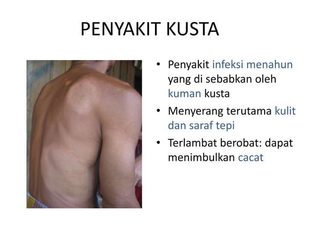 materi penyakit kusta untuk orang awam indonesia | PPTX