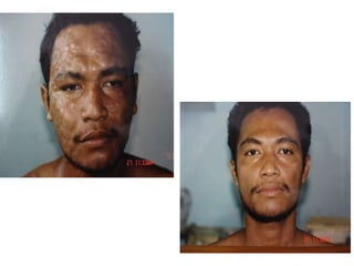 materi penyakit kusta untuk orang awam indonesia | PPTX