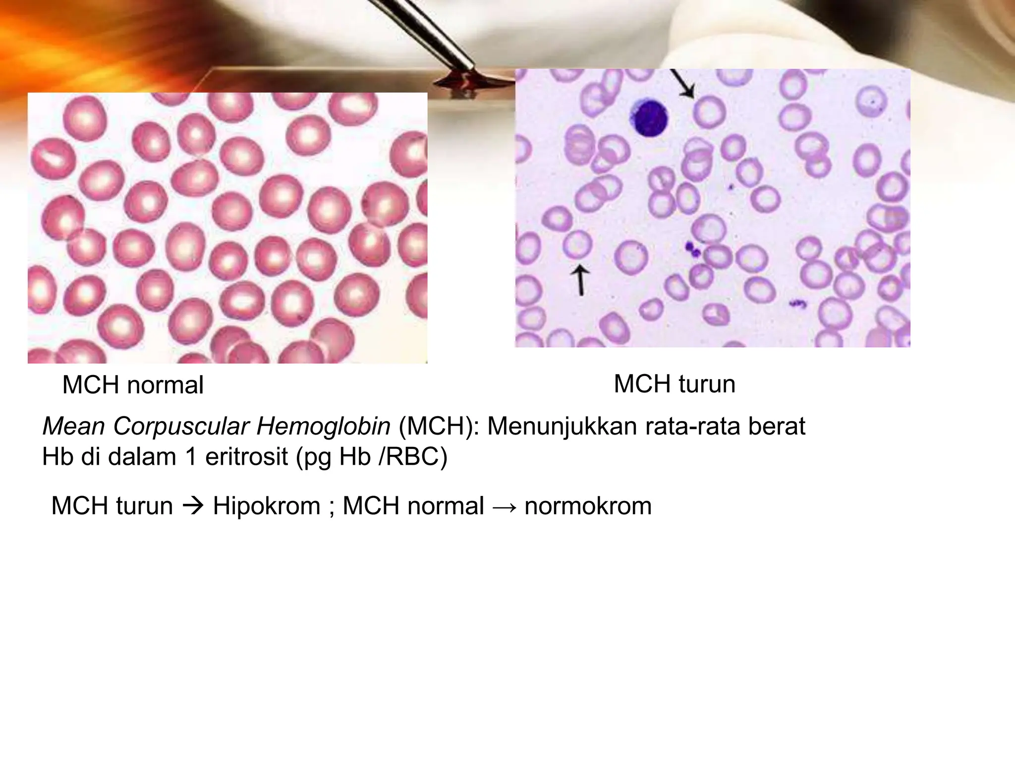 MATERI SEMINAR THALASSEMIA 5THALASSEMIApptx | PPTX