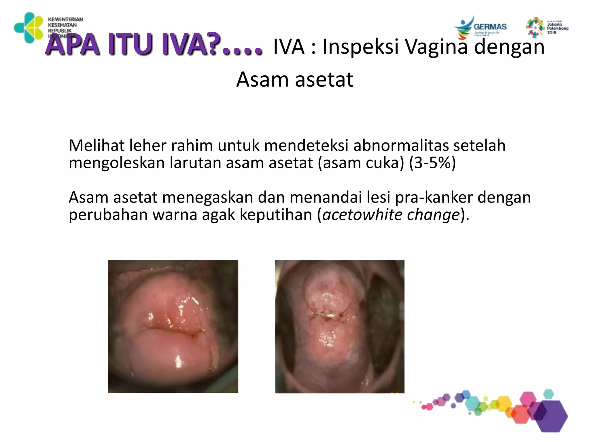 MATERI_SOSIALISASI_IVA_SADANIS.ppt