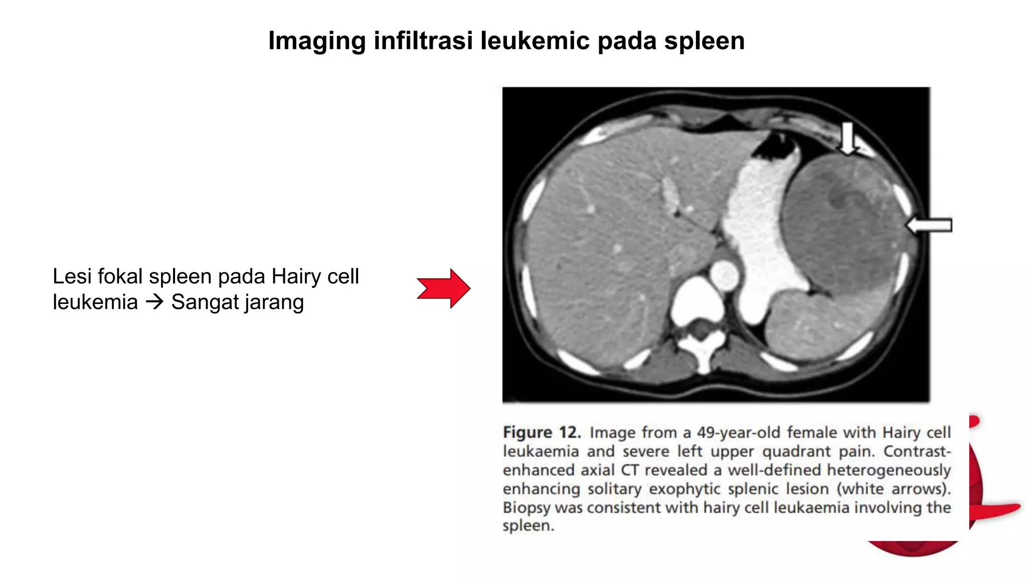 Imaging in leukemia | PPTX