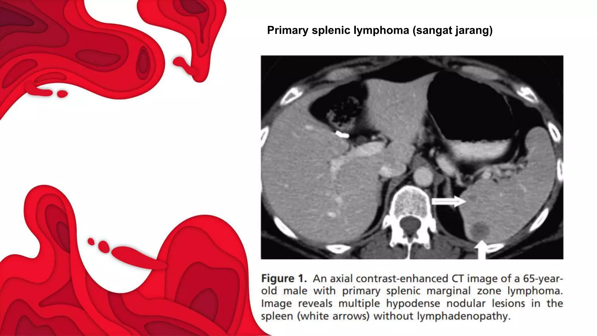 Imaging in leukemia | PPTX