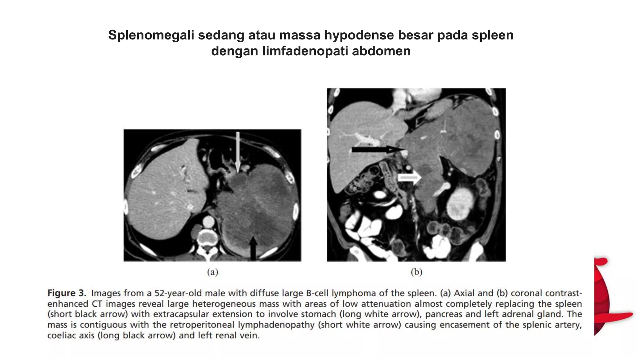 Imaging in leukemia | PPTX