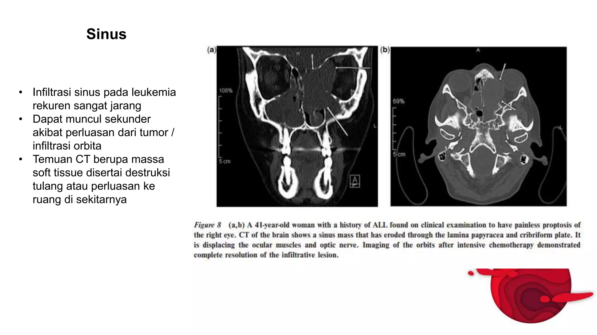 Imaging in leukemia | PPTX