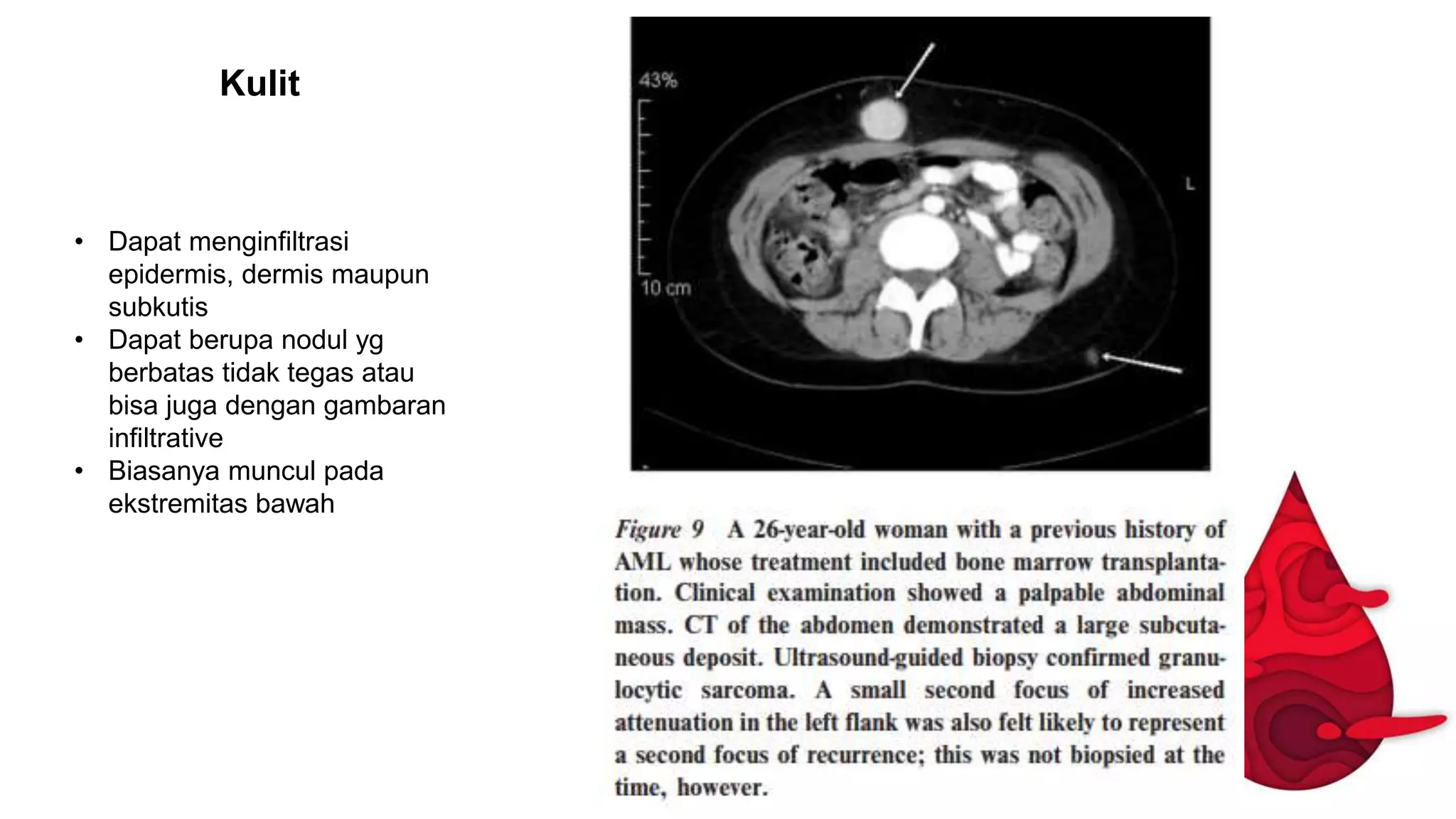 Imaging in leukemia | PPTX