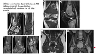 Imaging in leukemia | PPTX