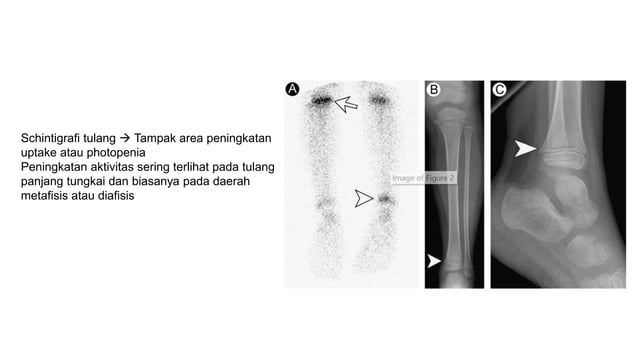Imaging in leukemia | PPTX