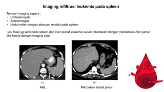 Imaging in leukemia | PPTX