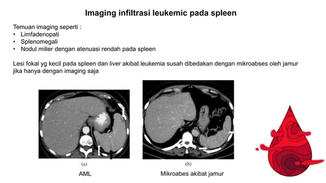 Imaging in leukemia | PPTX