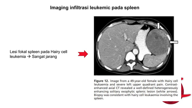 Imaging in leukemia | PPTX