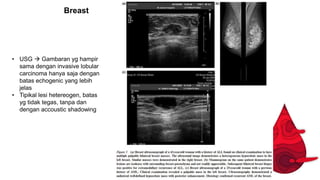 Imaging in leukemia | PPTX