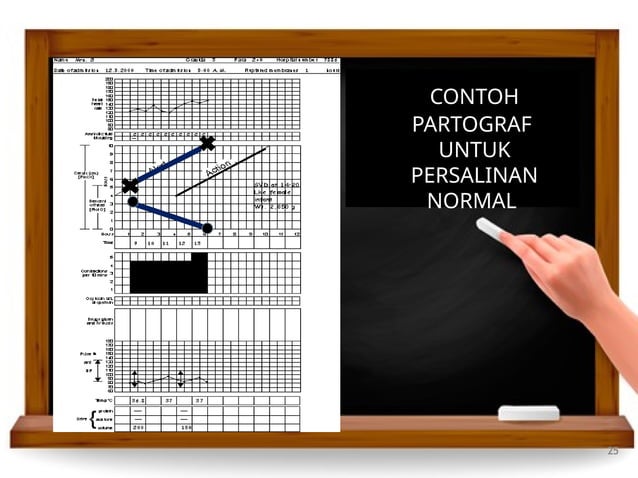 Materi Webinar Deteksi Komplikasi Kebidanan Intrapartum dengan PARTOGRAF.pptx