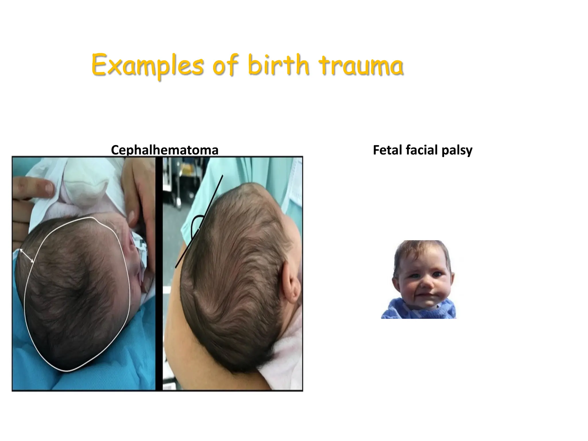 MATERNAL and FETAL INJURIES DURING LABOR.pdf