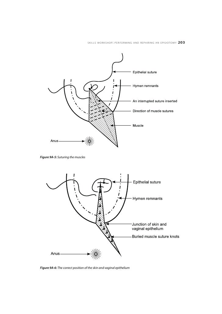 Maternal Care: Skills workshop Performing and repairing an episiotomy